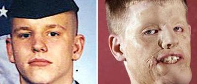 Mitch Hunter, ancien soldat défiguré après un terrible accident, revit ...