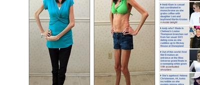 À 24 ans, la femme la plus maigre du monde pèse… 25kg! (photos+vidéo ...